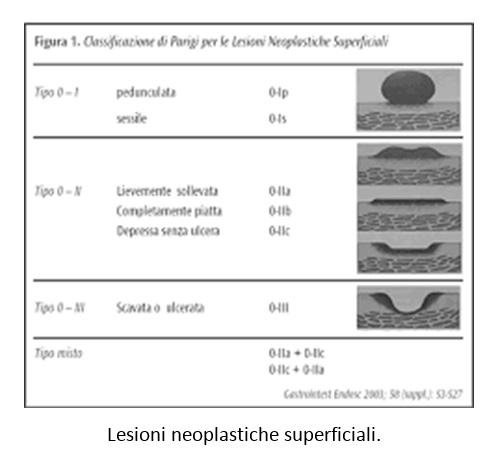 Classificazione polipi - Roma - Dott. Prof. Antonio Iannetti - Polipi ...