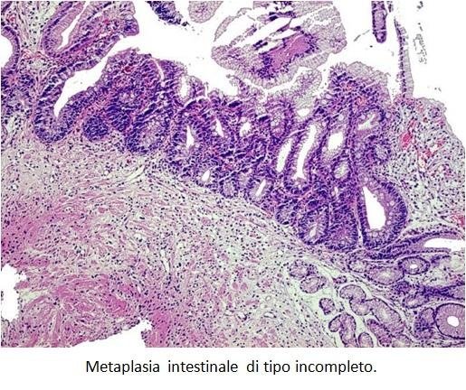 Gastrite acuta e cronica - Roma - Dott. Prof. Antonio Iannetti - Gastrite