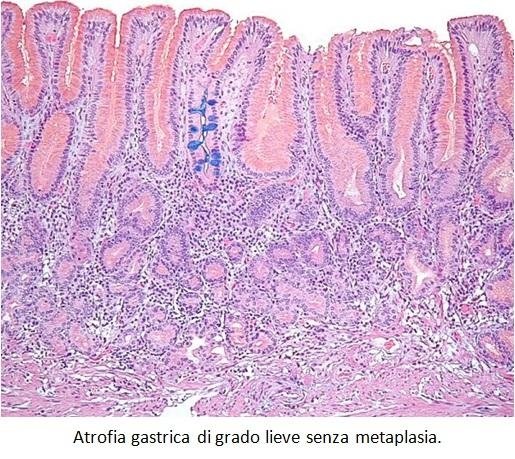 Gastrite acuta e cronica - Roma - Dott. Prof. Antonio Iannetti - Gastrite