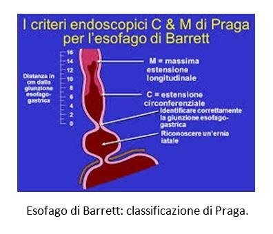 Malattia di Barrett - Roma - Dott. Prof. Antonio Iannetti - Esofago di ...