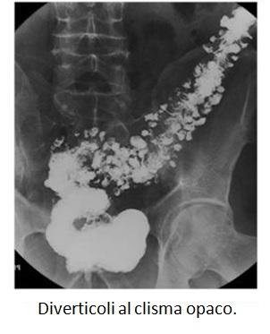 Diverticolosi - Roma - Dott. Prof. Iannetti - Diverticoli del colon