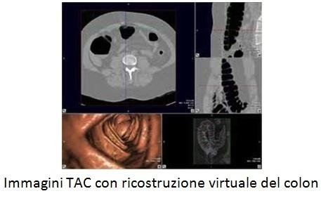 Endoscopia digestiva - Roma - Dott. Prof. Iannetti - Colonscopia ...