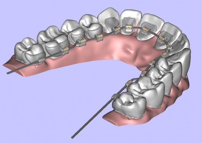 Harmony – Behind The Teeth Braces | Available in Mississauga