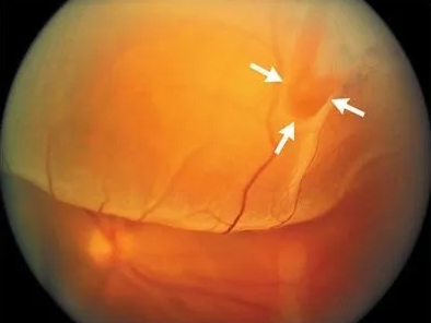 What are Flashes and Floaters? - Visionary Eye Surgeons