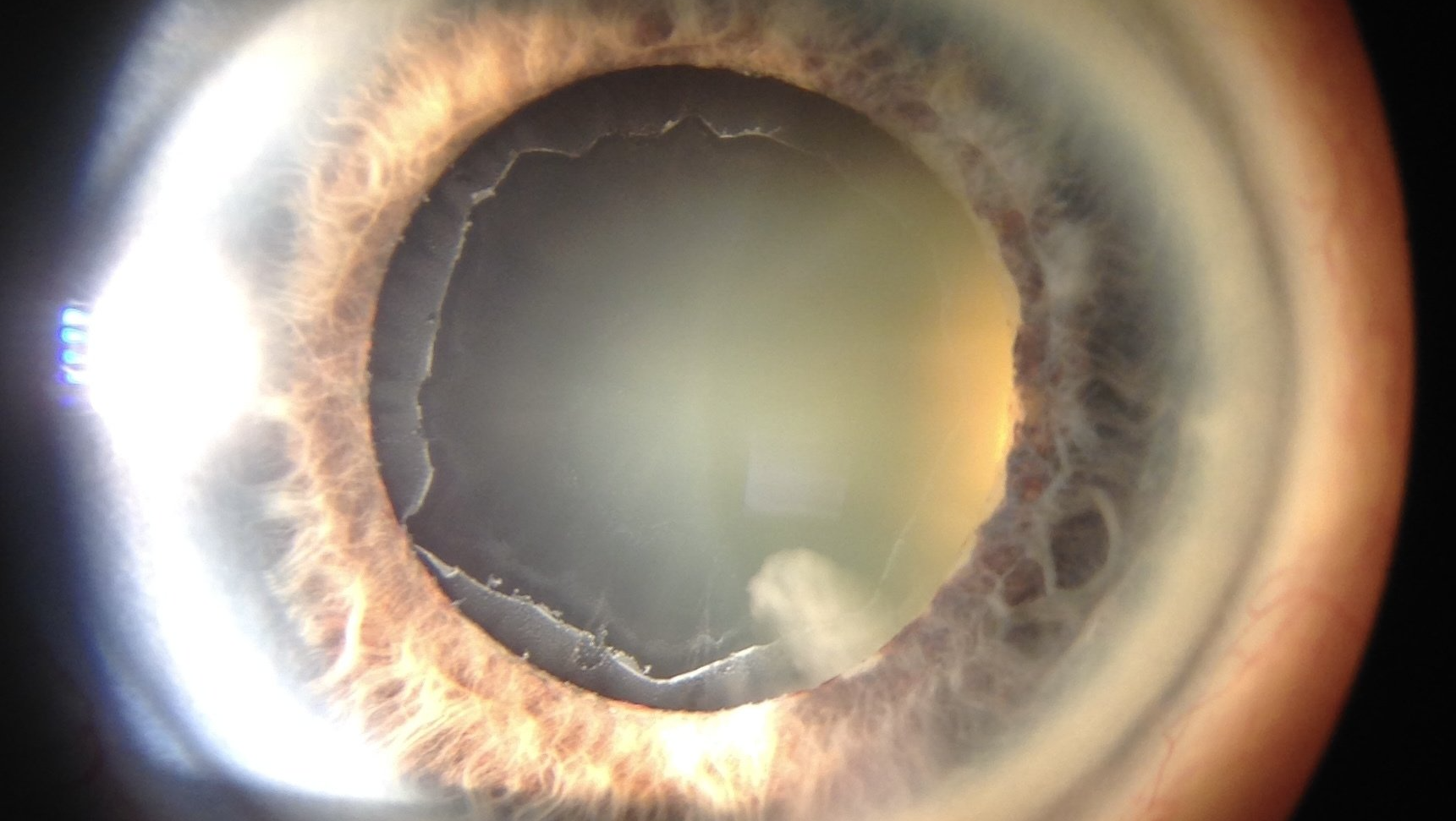 What are Cataracts? - Visionary Eye Surgeons