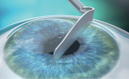 What is PRK? - Visionary Eye Surgeons