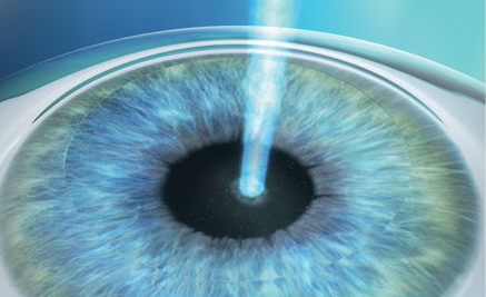 What is PRK? - Visionary Eye Surgeons