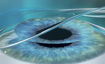 What is PRK? - Visionary Eye Surgeons