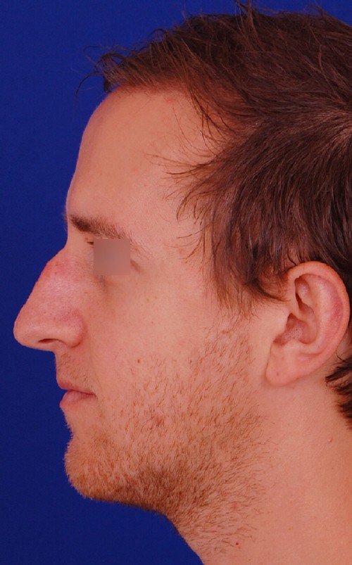 Rhinoplasty From Every Angle