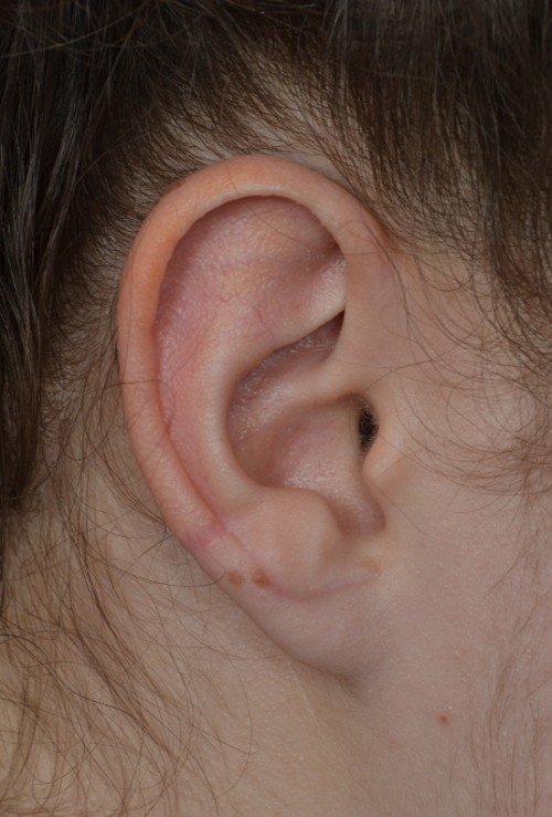 Common Earlobe Issues and Procedures To Correct Them