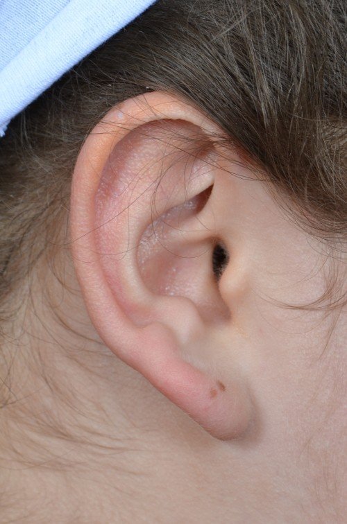 Common Earlobe Issues and Procedures To Correct Them