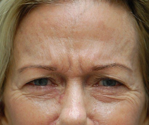 Dynamic vs. Static Wrinkles: What Are The Treatments?