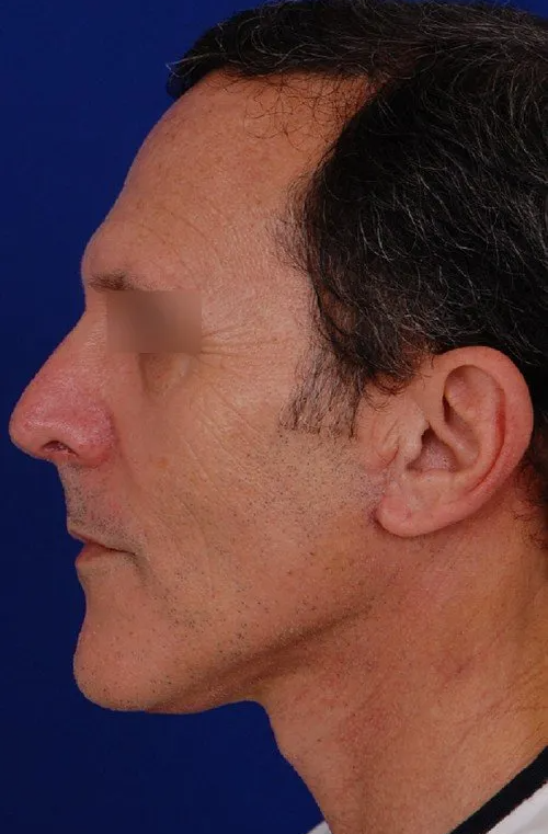 Before & After Mini Facelift Photos | Viságe Facial Plastic Surgery