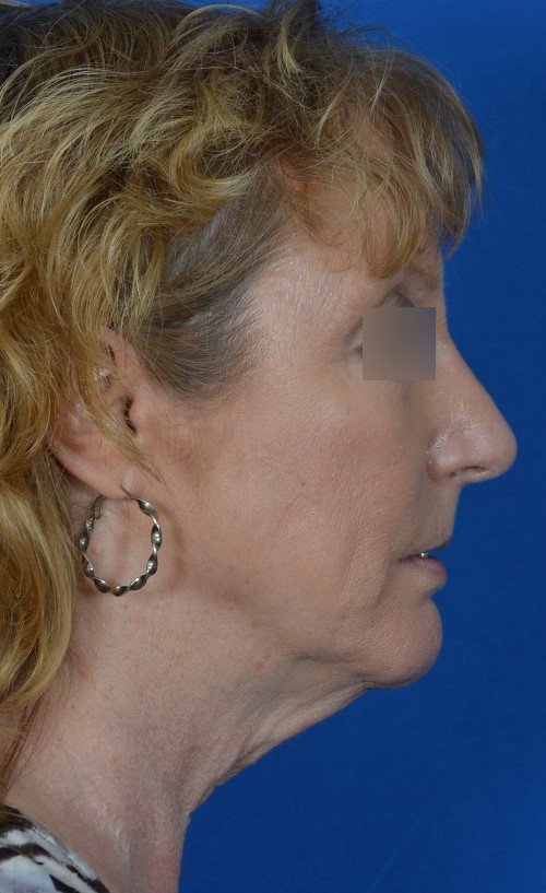 Impressive Patient Transformations at Visage Facial Plastic Surgery