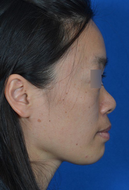 How Rhinoplasty Can Reshape The Bridge Of The Nose