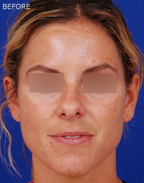Types of Rhinoplasty: Nose Reshaping Options Explained