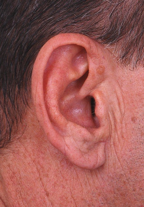 Common Earlobe Issues and Procedures To Correct Them