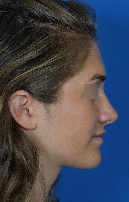 Rhinoplasty From Every Angle