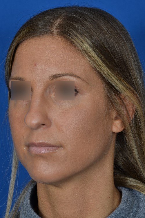 Rhinoplasty From Every Angle