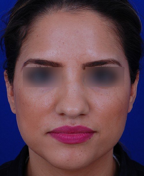 Rhinoplasty From Every Angle