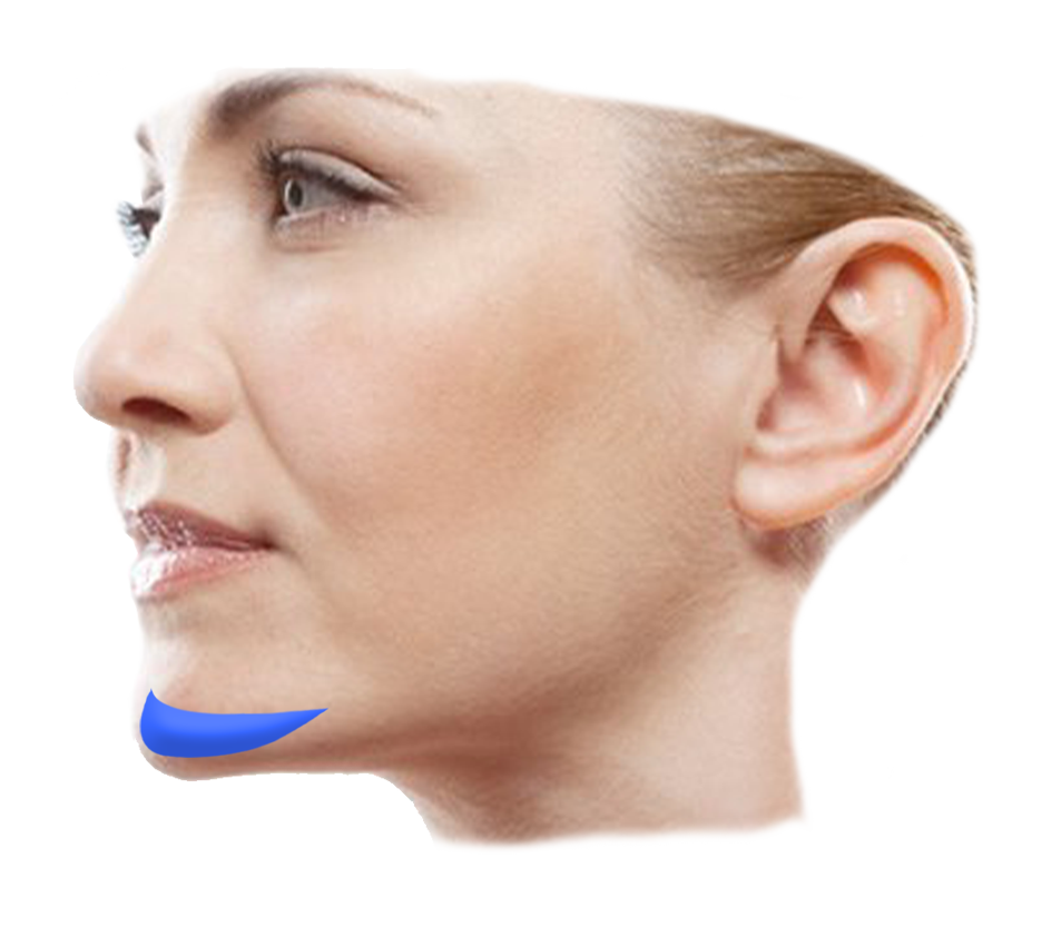 Facial Implants: The Permanent "Filler"