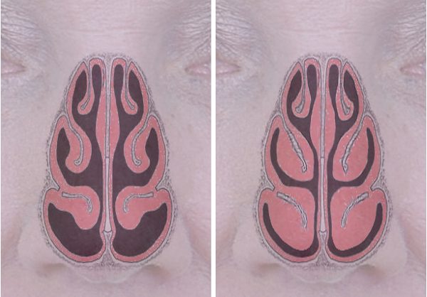 Normal Nasal Turbinates
