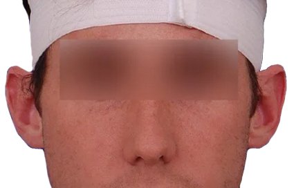 Otoplasty: The "Ear Pinning" Procedure For Protruding Ears