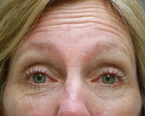 Dynamic vs. Static Wrinkles: What Are The Treatments?