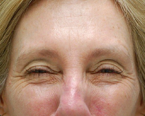 Dynamic vs. Static Wrinkles: What Are The Treatments?
