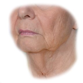 Dynamic vs. Static Wrinkles: What Are The Treatments?