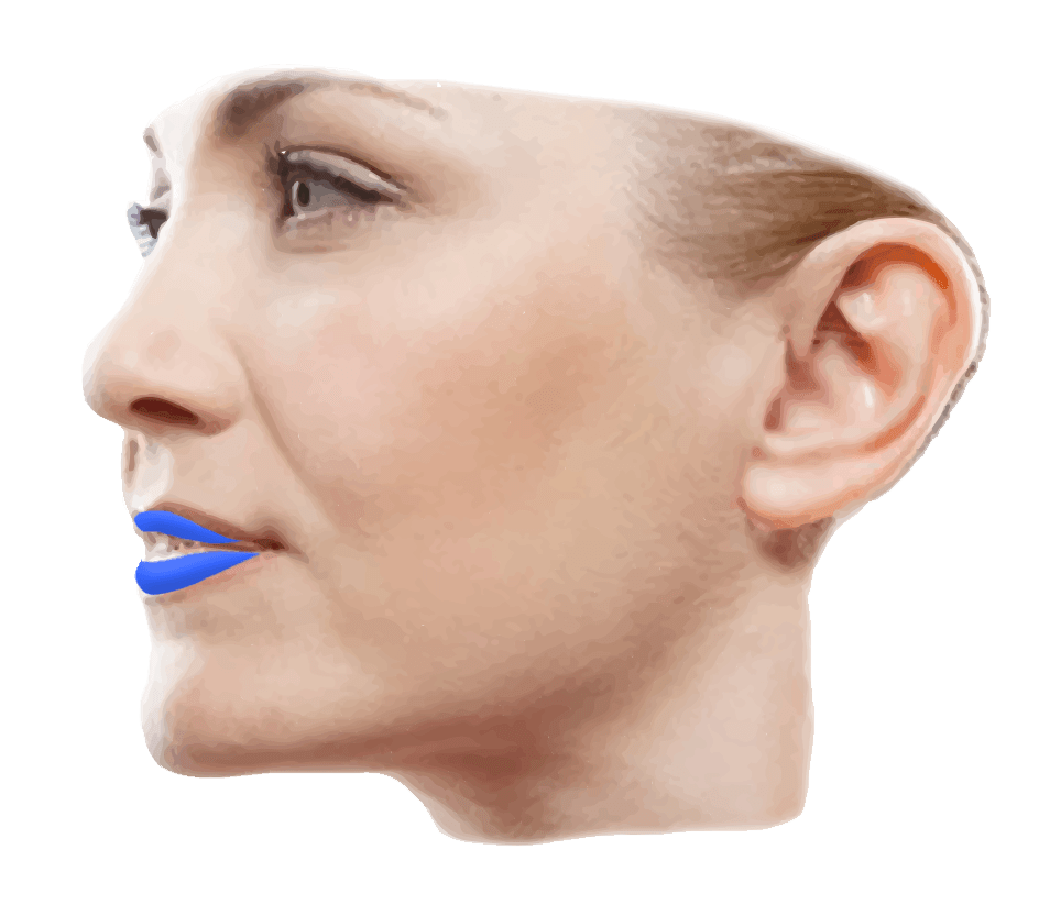 Facial Implants: The Permanent "Filler"