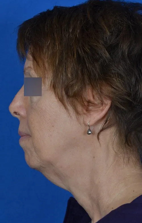 Before & After Mini Facelift Photos | Viságe Facial Plastic Surgery