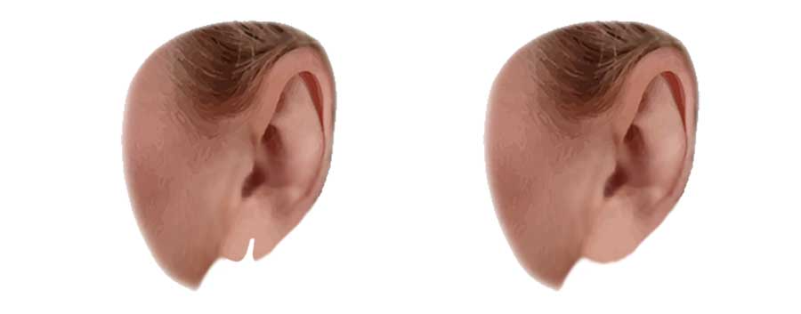 Repairing Torn Earlobes With Split Earlobe Repair Surgery