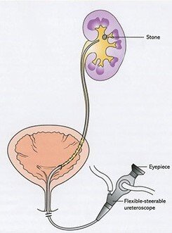 Laser Stone Surgery | Treatments | Bayside Urology | Queensland