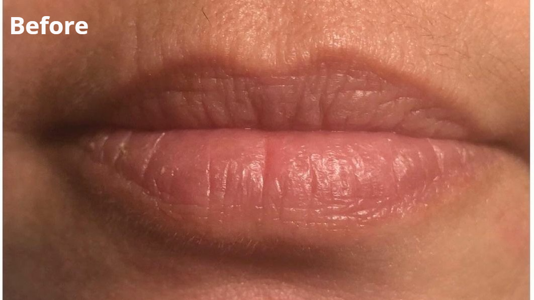 Hyaluron Pen - Needleless Filler | Skyn Deep Medical Spa | San Diego