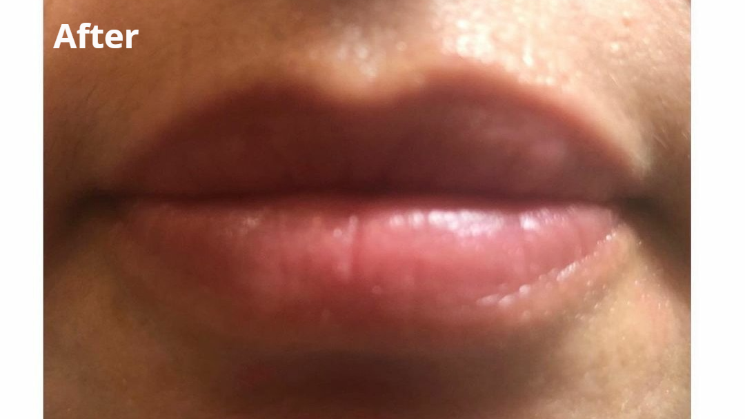 Hyaluron Pen - Needleless Filler | Skyn Deep Medical Spa | San Diego