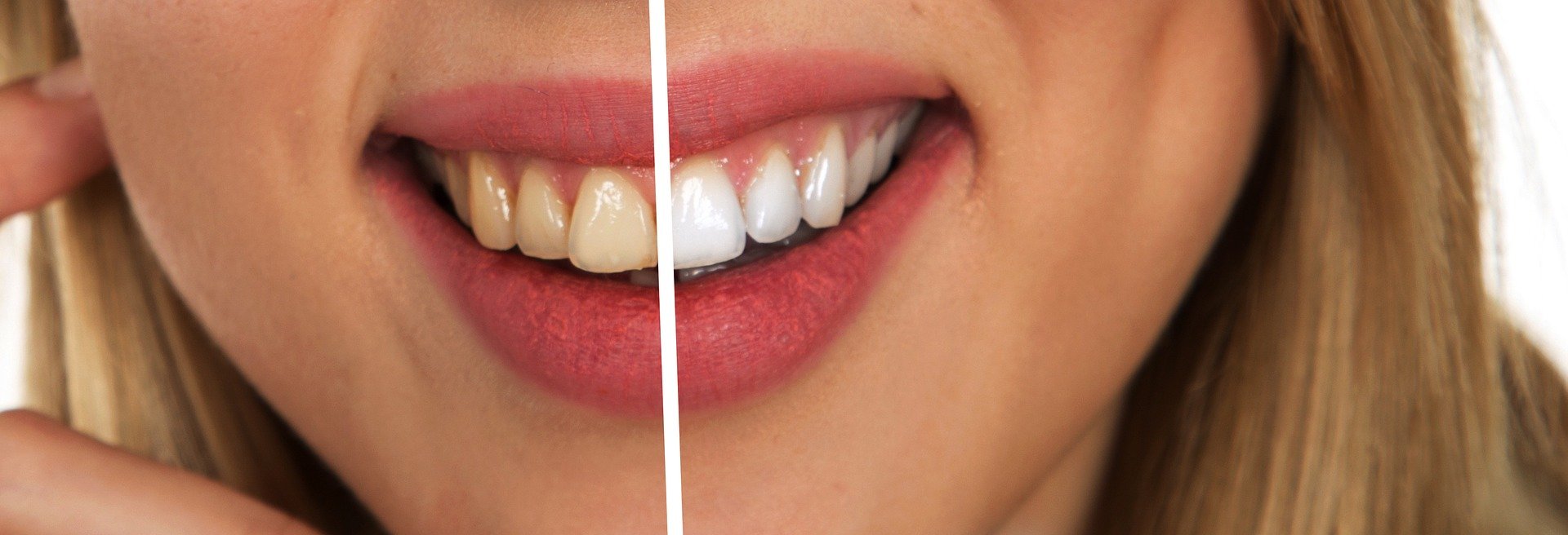 How Long Does Teeth Whitening Last?