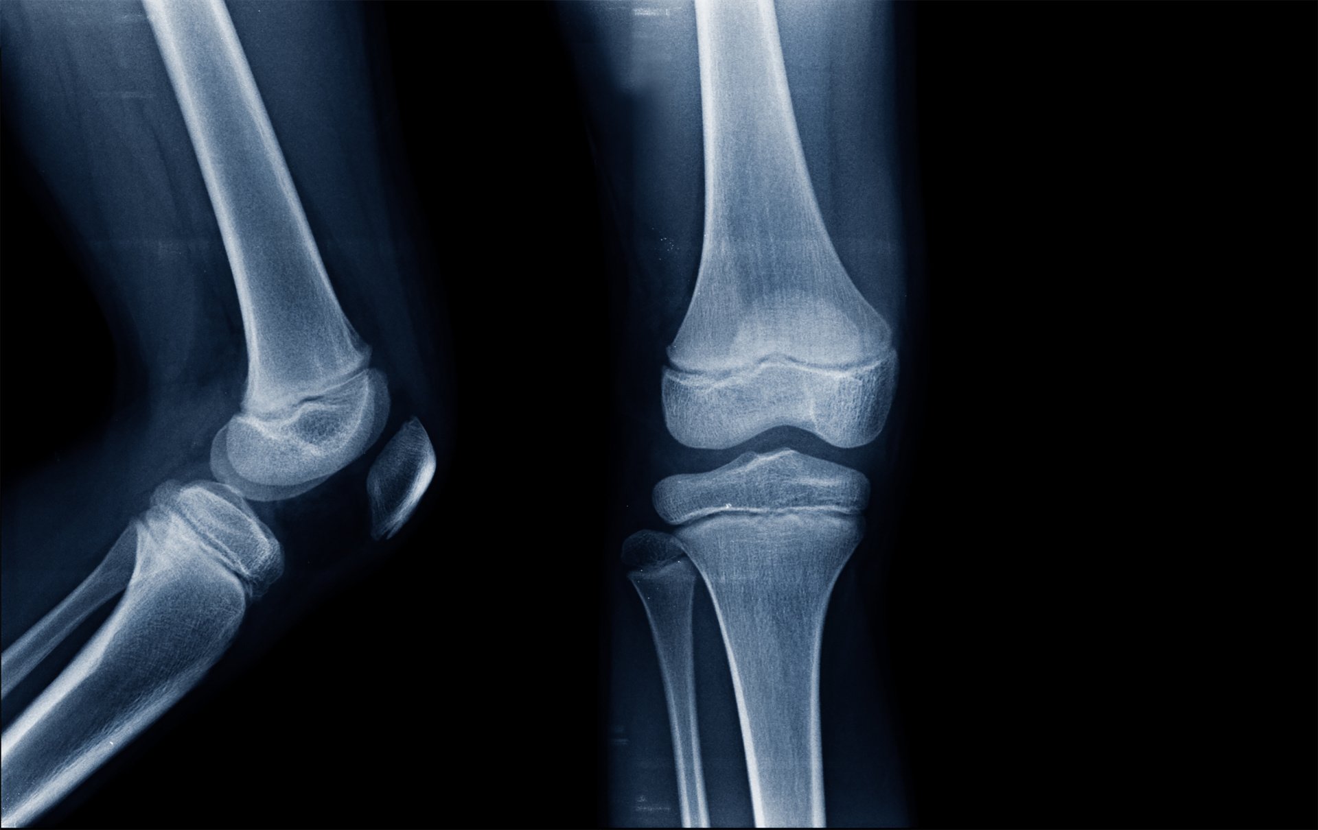 Anterior Cruciate Ligament (ACL) Injury in Children | Dr A Theodorides
