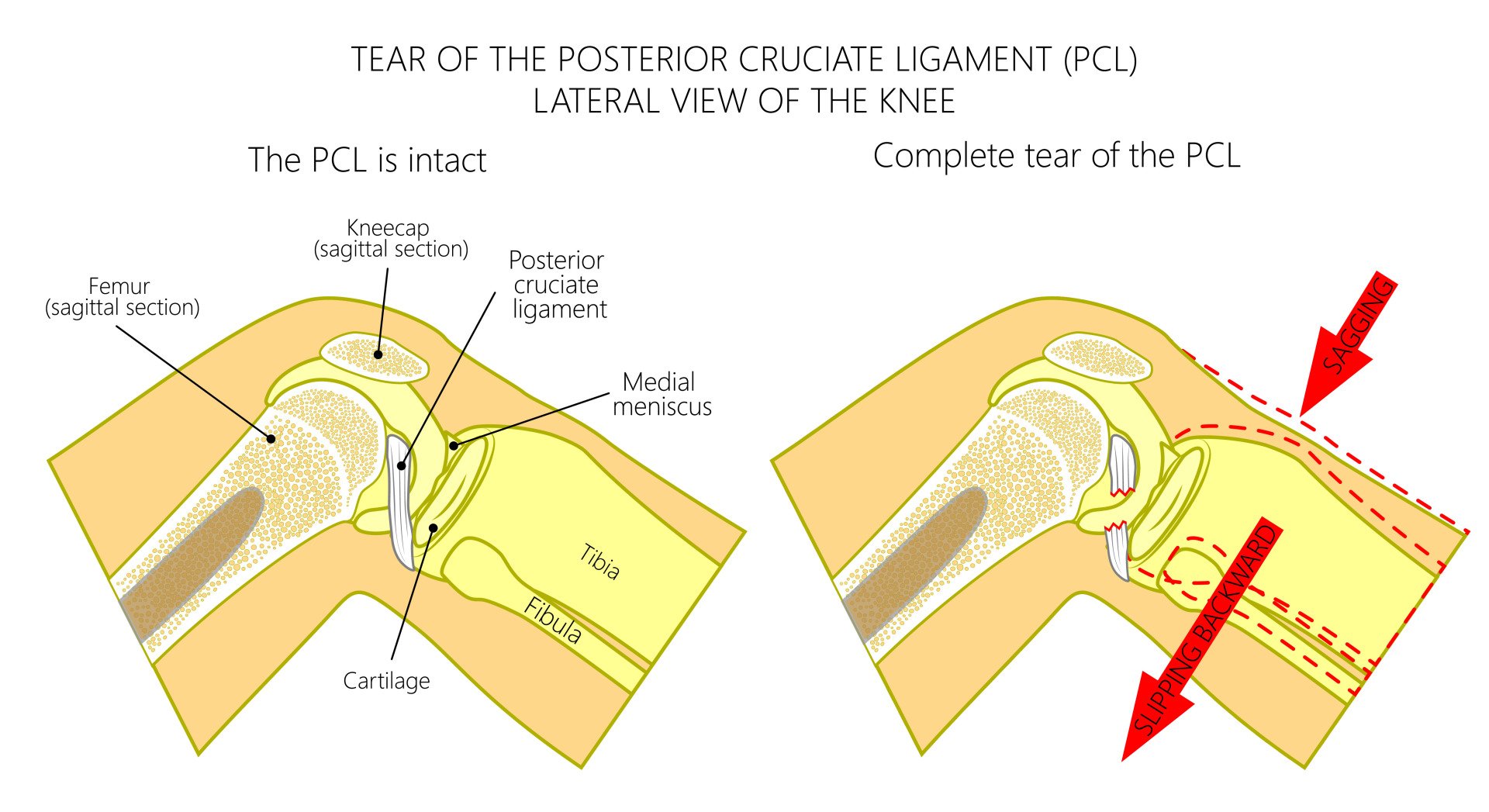 Posterior Cruciate Ligament (PCL) Injury - Symptoms - Treatment