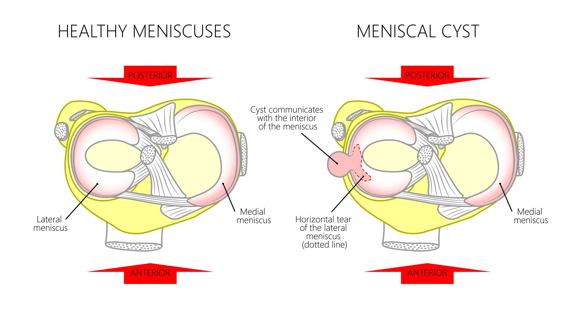 Meniscal Cyst Knee arthroscopy - Treatment | Dr A Theodorides | Knee ...