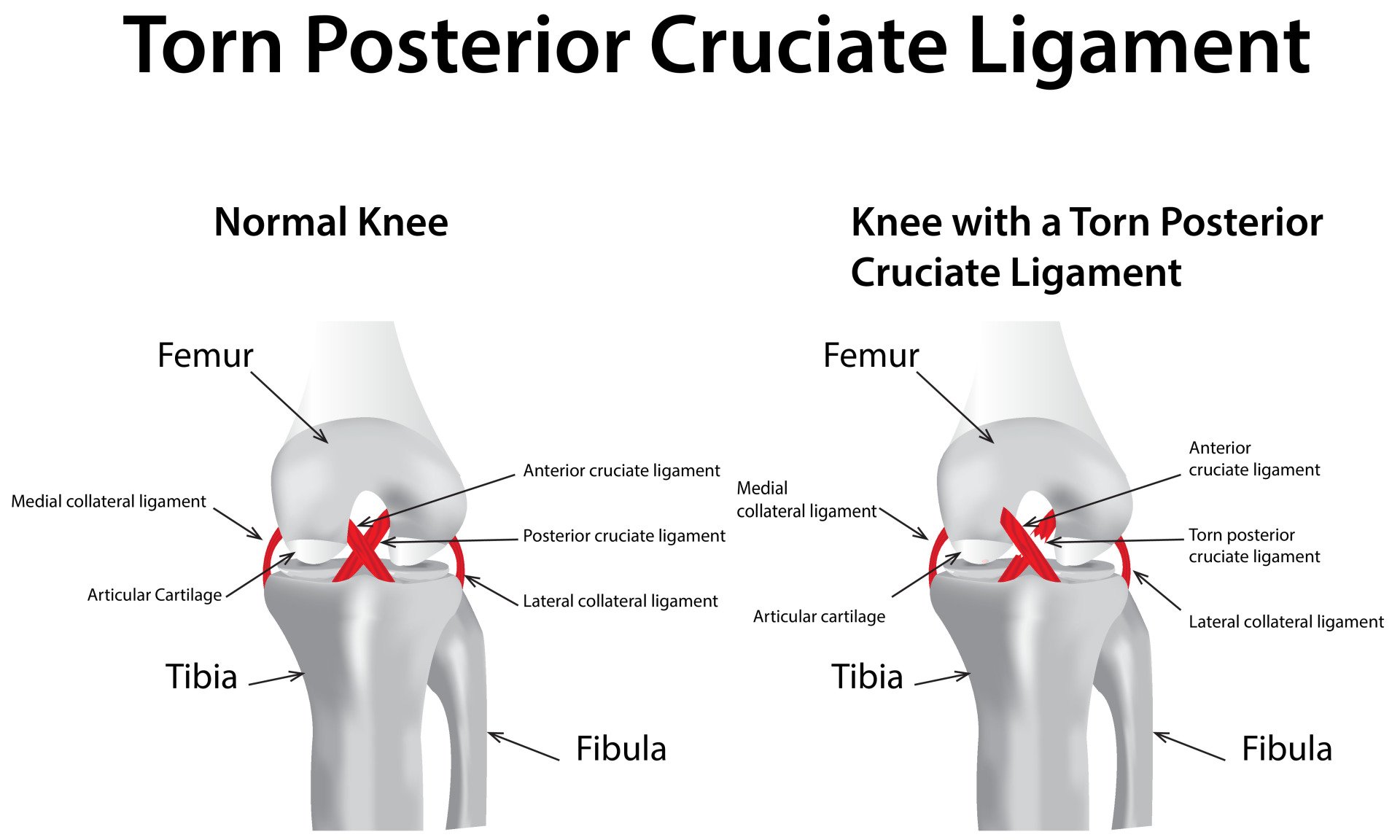 Posterior Cruciate Ligament (PCL) Injury - Symptoms - Treatment