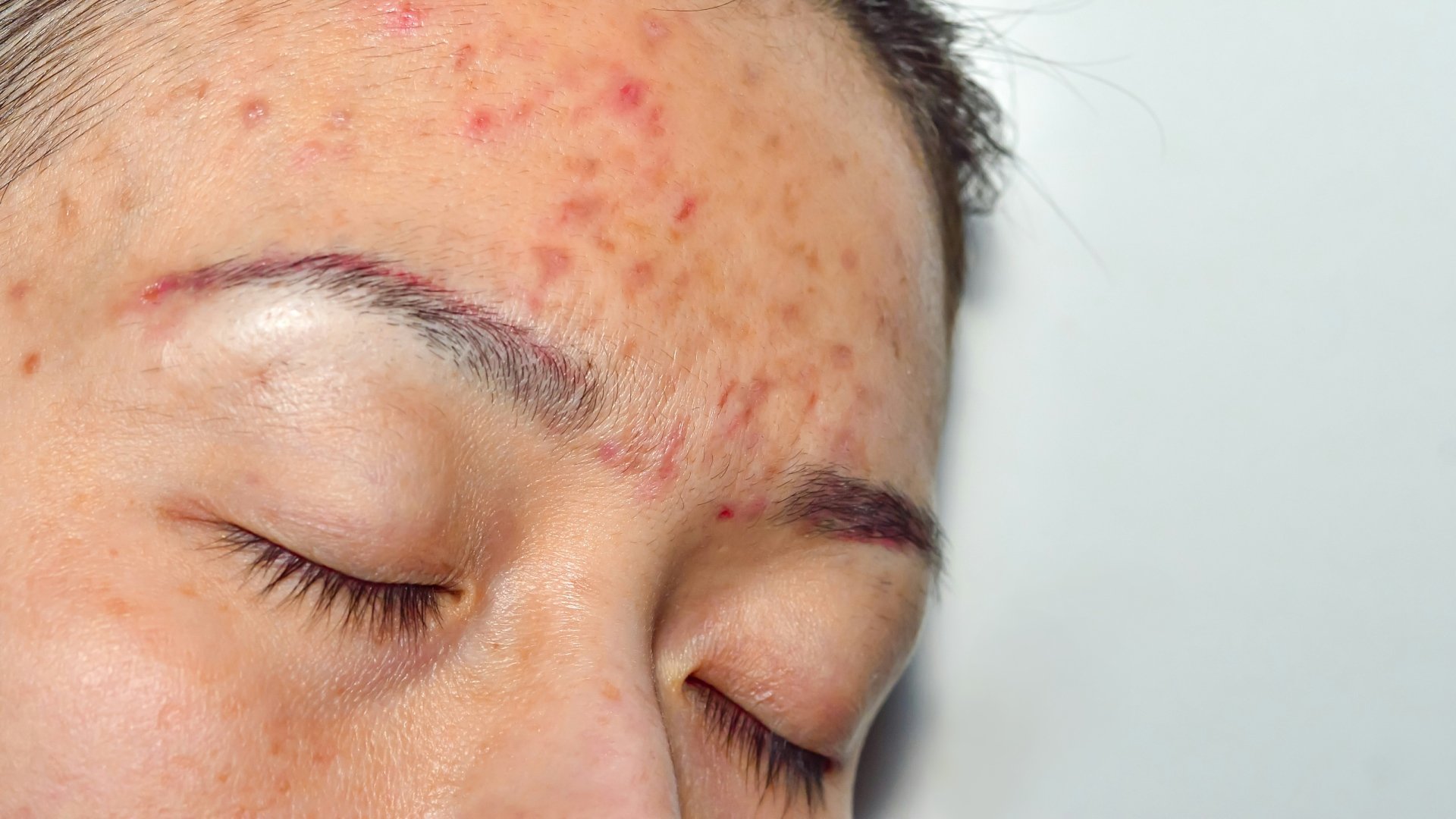 Acne & Rosacea | Laser Health Works | Barrie, ON