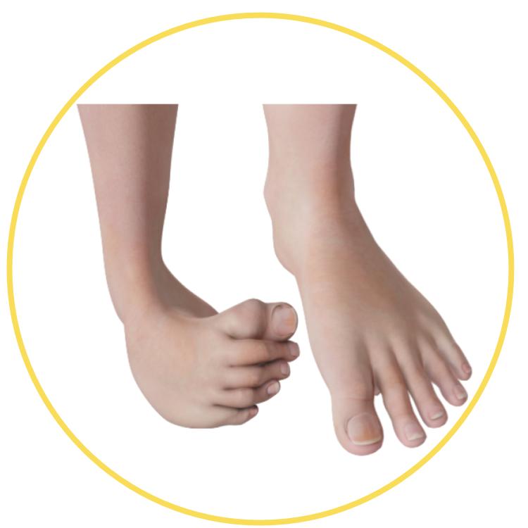 Club Foot - Bunbury Foot & Ankle Surgeon