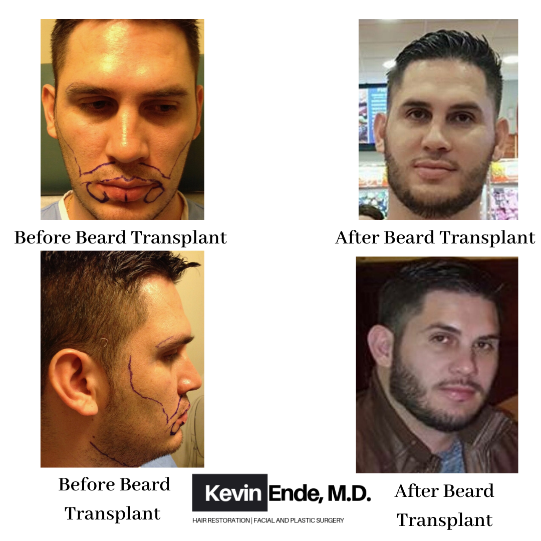 Facelift | Englewood, NJ | Dr. Kevin Ende, M.D.