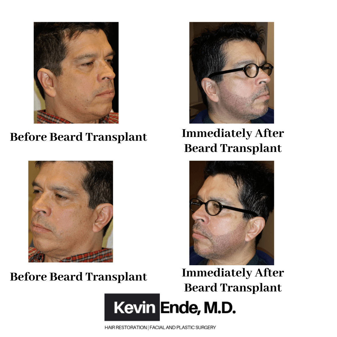 Facelift | Englewood, NJ | Dr. Kevin Ende, M.D.