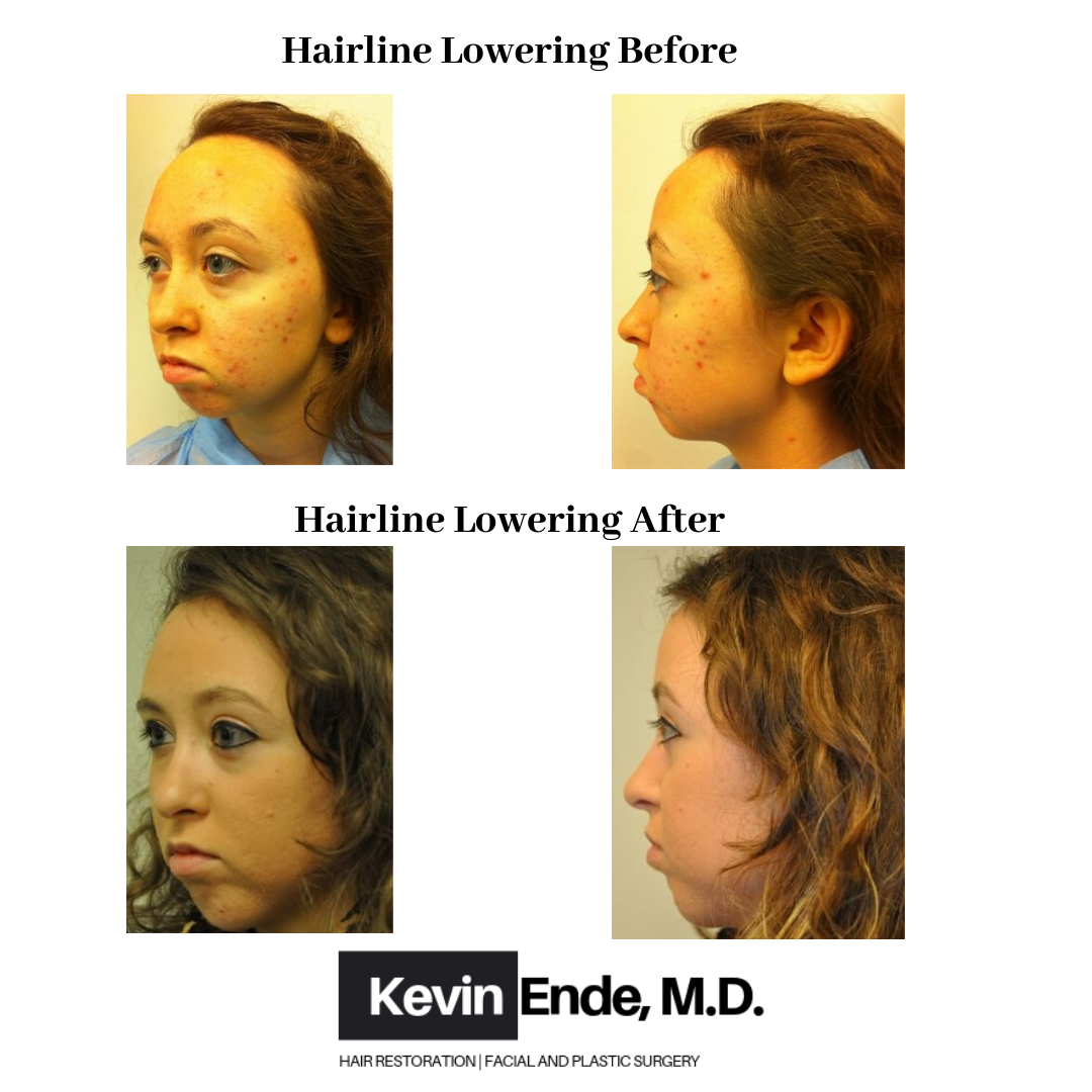 Facelift | Englewood, NJ | Dr. Kevin Ende, M.D.