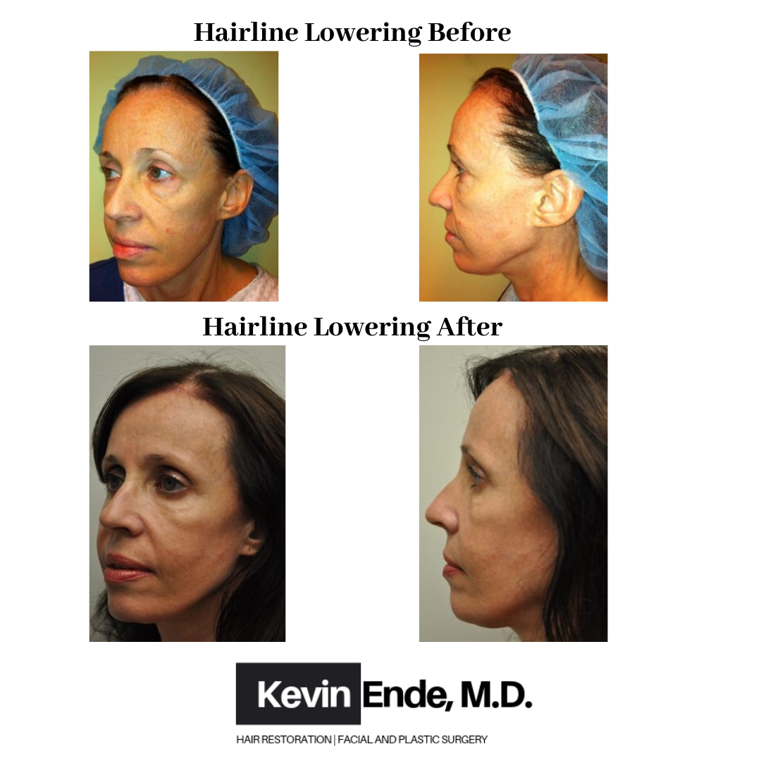 Facelift | Englewood, NJ | Dr. Kevin Ende, M.D.