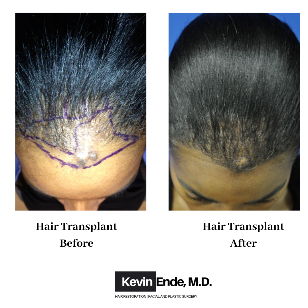 Facelift | Englewood, NJ | Dr. Kevin Ende, M.D.