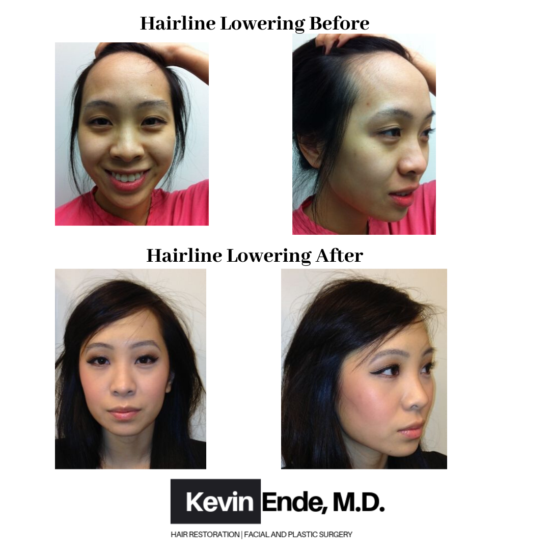 Facelift | Englewood, NJ | Dr. Kevin Ende, M.D.