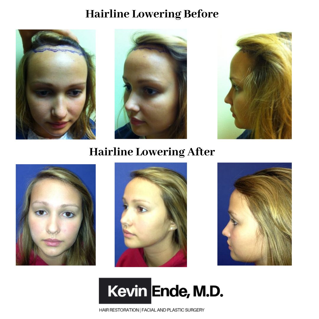 Facelift | Englewood, NJ | Dr. Kevin Ende, M.D.